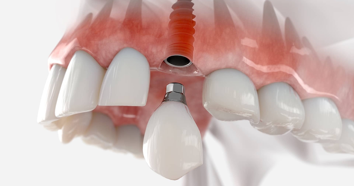 Próteses Fixas | Clínica Médica e Dentária das Tílias